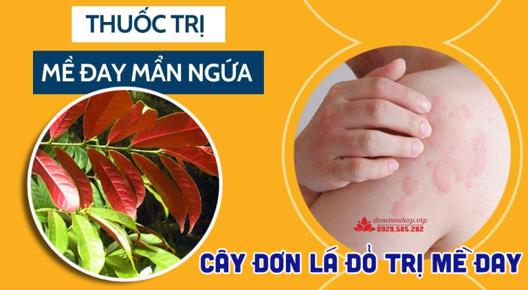 Bệnh mày đay, nguyên nhân, triệu chứng và cách điều trị